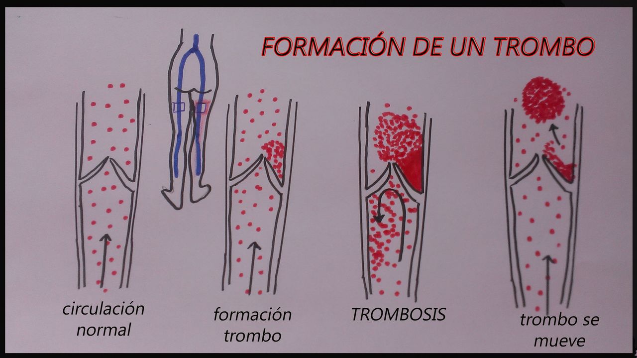 Cuidando prótesis mitral: ¿QUÉ DIFERENCIA HAY ENTRE TROMBOSIS Y EMBOLIA?